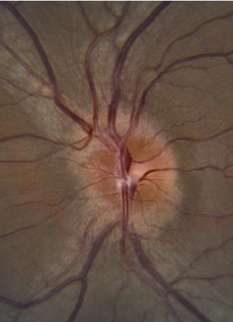 Neuro-oph Case 3: Physical Exam