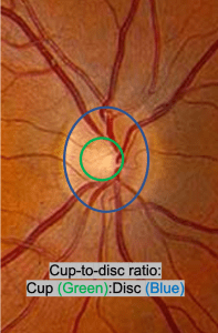 Peds Ophtho Case 3: Case Continued…
