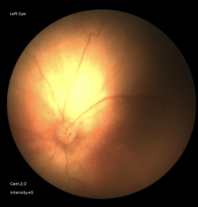 Peds Ophtho Case 4: Additional History & PHYSICAL EXAM