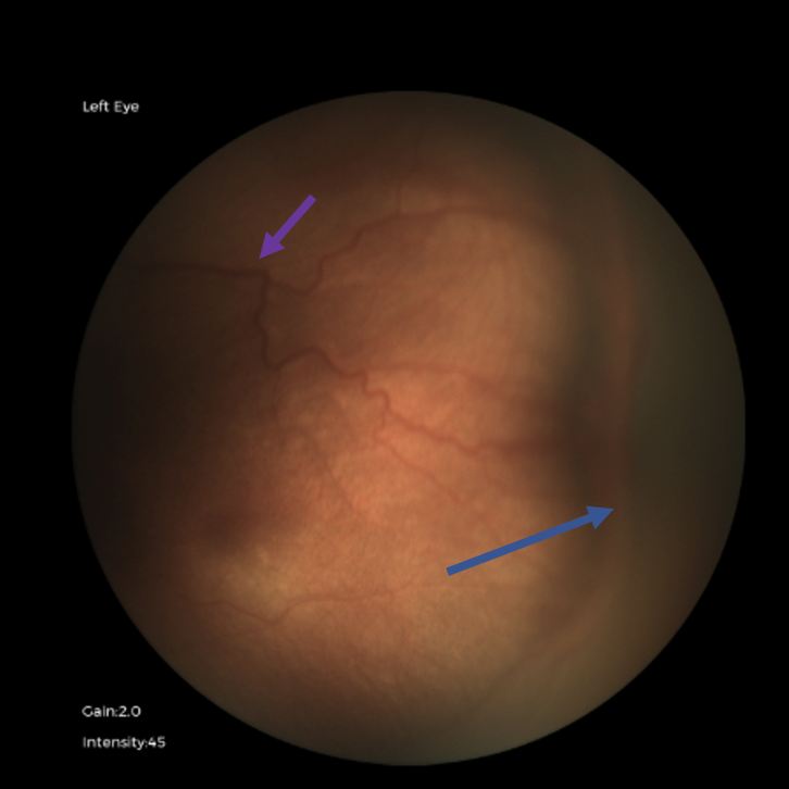 Peds Ophtho Case 4: Dilated Fundus Exam